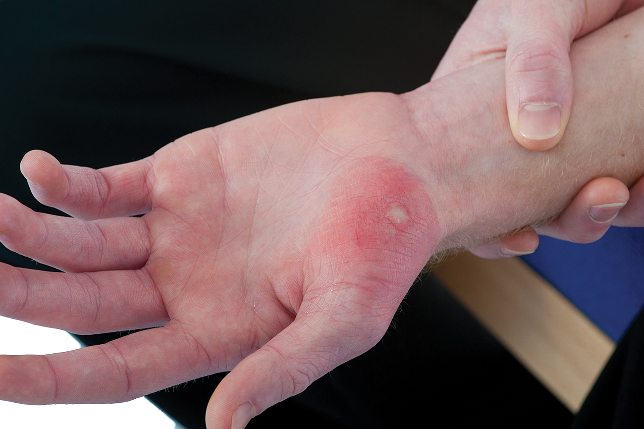 Partial thickness burns – E-Learning