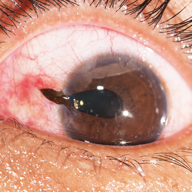 Lacerations of the eye – E-Learning